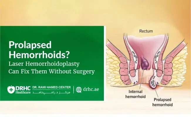 Prolapsed Hemorrhoids? Laser Hemorrhoidoplasty Can Fix Them Without Surgery